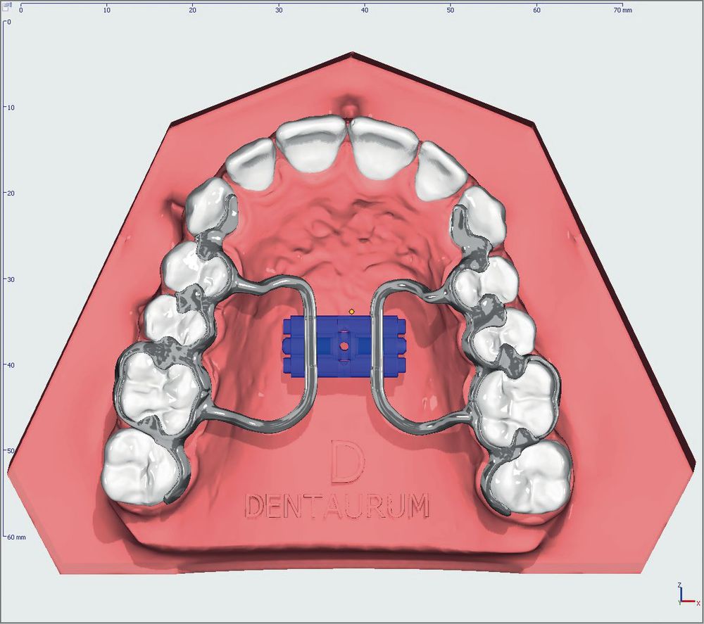 hyrax® neo Medium – 10, recto - DENTAURUM España Online Shop
